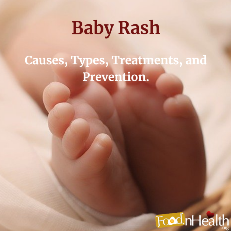 Baby Rash: Causes, Types, Treatments, and Prevention - Food N Health